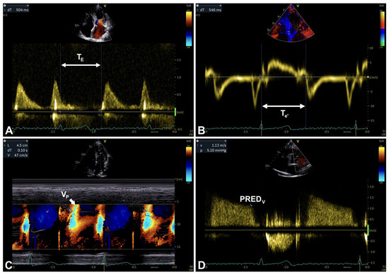 Echocardiographic Assessment of Left Ventricular Diastolic Function in ...
