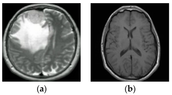 Mri Based Brain Tumor Classification Using A Dilated Parallel Deep Convolutional Neural Network
