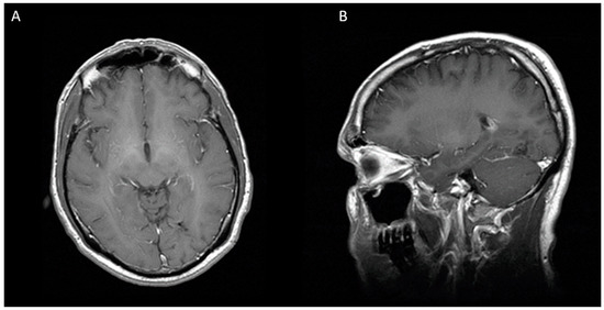 Pyogenic Brain Abscess Caused by Peptostreptococcus in a Patient with ...