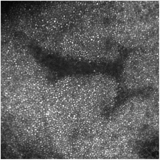 Role of Handheld In Vivo Reflectance Confocal Microscopy for the ...