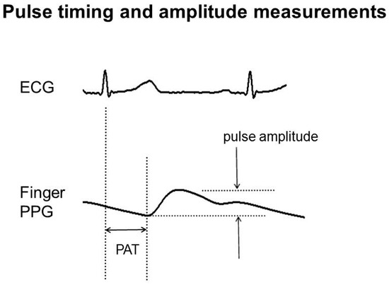 Innovative Multi-Site Photoplethysmography Analysis for Quantifying ...