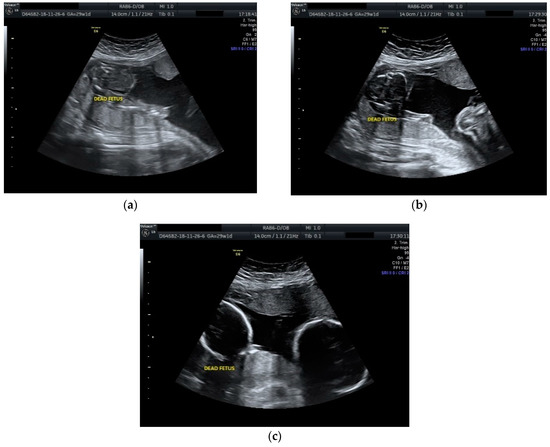 Single Fetal Demise in Twin Pregnancy—A Great Concern but Still a ...