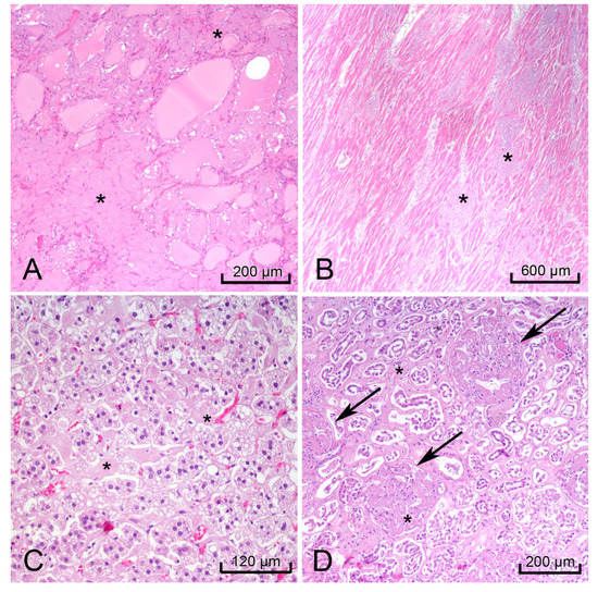 Diseases Free Full Text Negative Fat Pad Biopsy In Systemic Al A Case Report Analyzing The