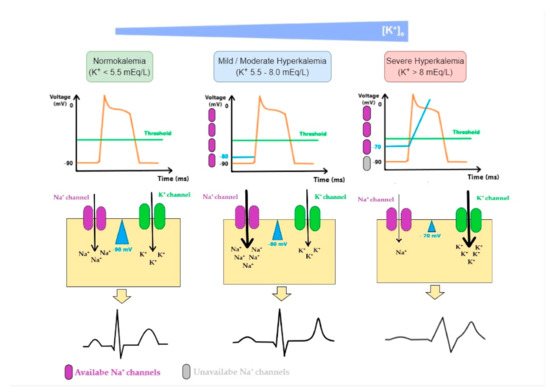 Hyperkalemia in Diabetes Mellitus Setting