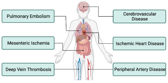 Thromboembolic Events in Patients with Inflammatory Bowel Disease: A ...