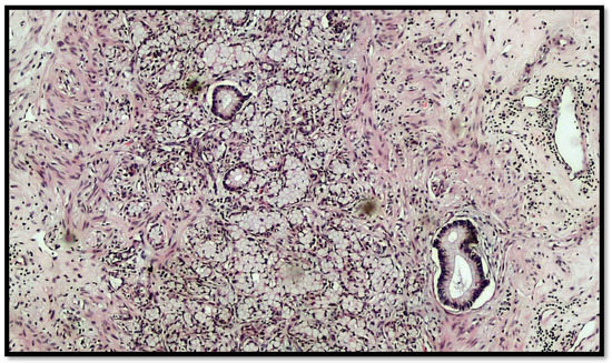 Diseases | Free Full-Text | Goblet Cell Carcinoma of the Appendix with ...