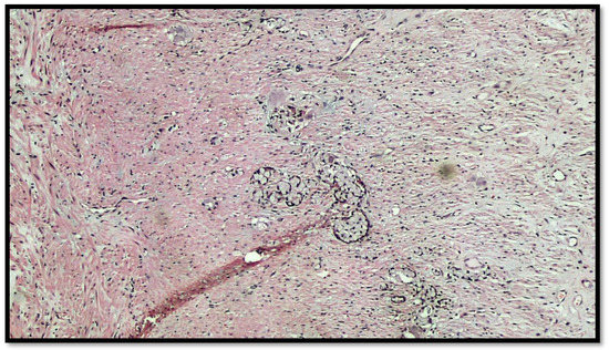 Goblet Cell Carcinoma of the Appendix with Synchronous Adenocarcinoma ...