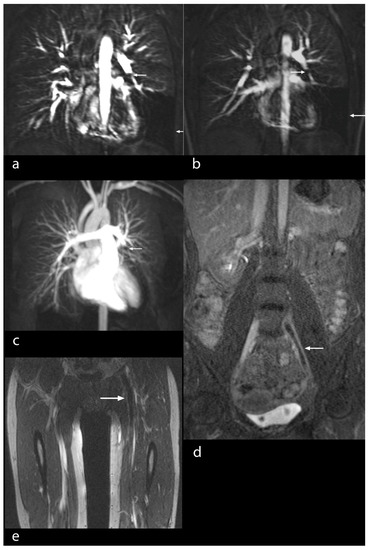 Venogram Venous Occlusive Disease