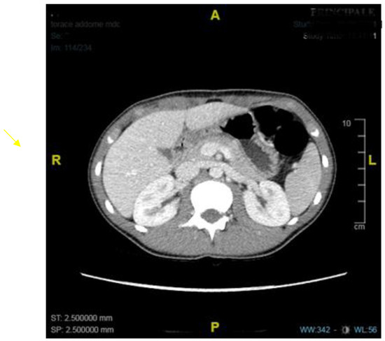 Hypertrophic Pyloric Stenosis in an Adolescent Girl: An Atypical ...