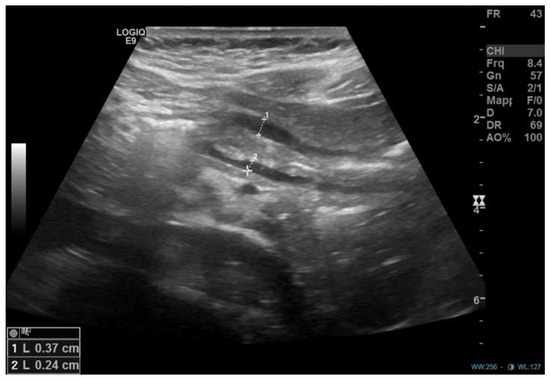 Hypertrophic Pyloric Stenosis in an Adolescent Girl: An Atypical ...