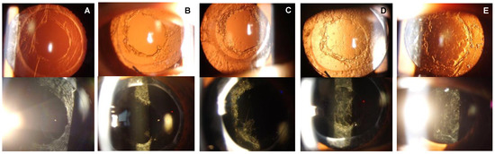 Factors Associated with Reclosure of Posterior Capsule Aperture by Flat ...
