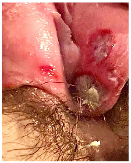 Blisters on vulva store