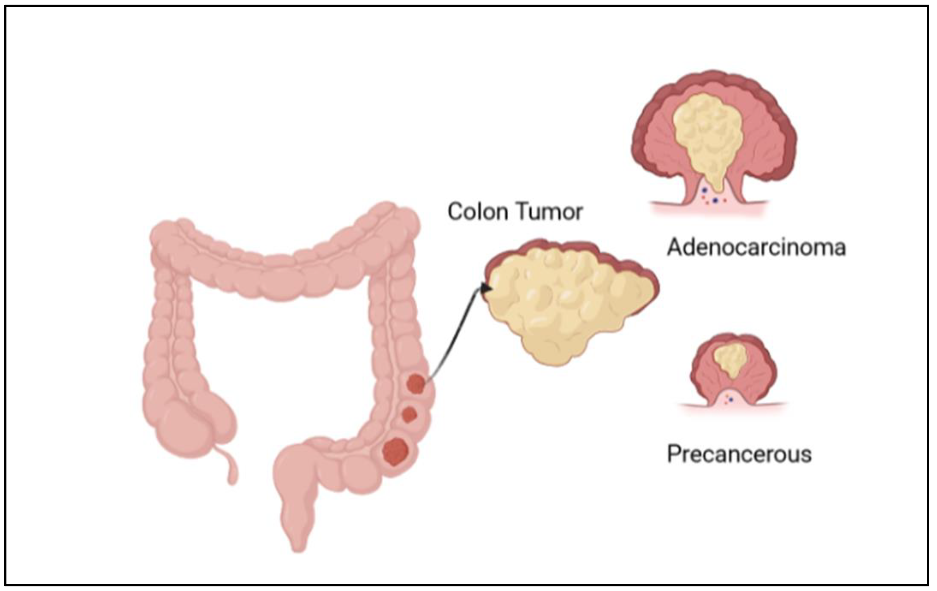Progress and Perspectives in Colon Cancer Pathology, Diagnosis, and Treatments