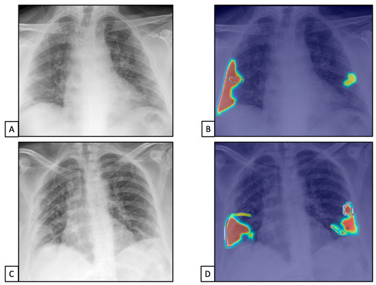 Artificial Intelligence Applied to Chest X-ray: A Reliable Tool to ...