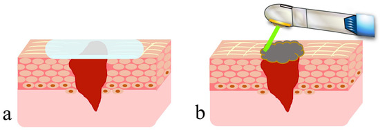 CO2 Laser for Esthetic Healing of Injuries and Surgical Wounds with ...