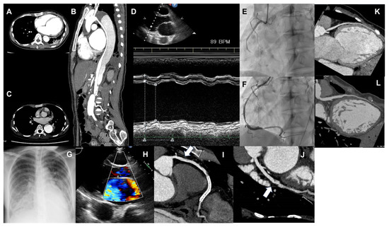 Multivessel Coronary Artery Dissection in a Patient with Co-Occurrence ...