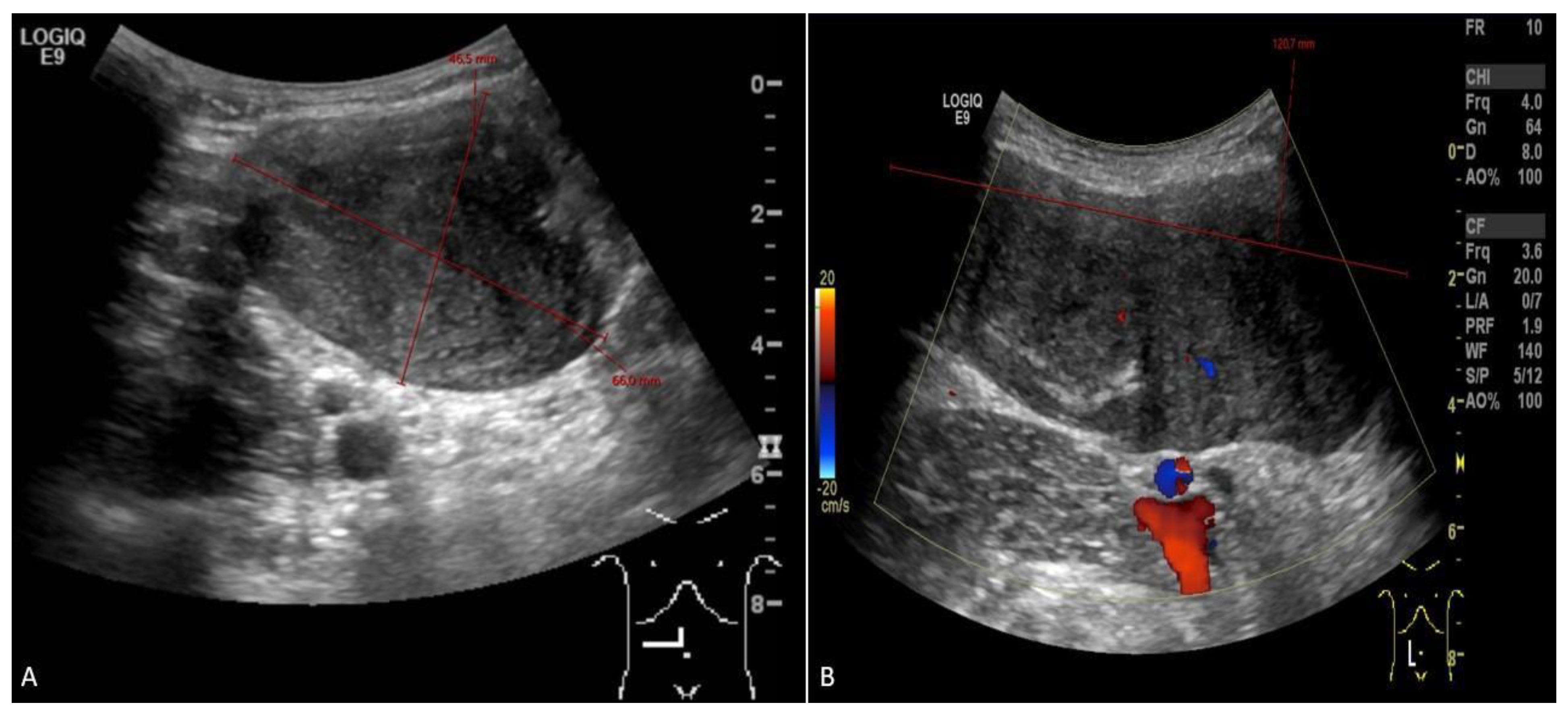 Desmoid Fibromatosis of the Anterior Abdominal Wall in Pregnancy: A ...