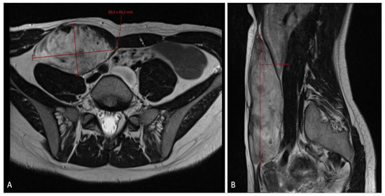 Desmoid Fibromatosis of the Anterior Abdominal Wall in Pregnancy: A ...