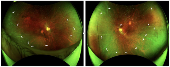 Long Vax in the Eye: Long Post-COVID Vaccination Syndrome Presenting ...