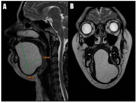 Diseases | Free Full-Text | Giant Sublingual, Submental, and Lingual ...