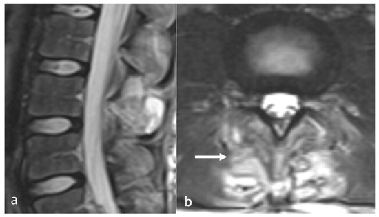 Anatomy and Pathologies of the Spinous Process