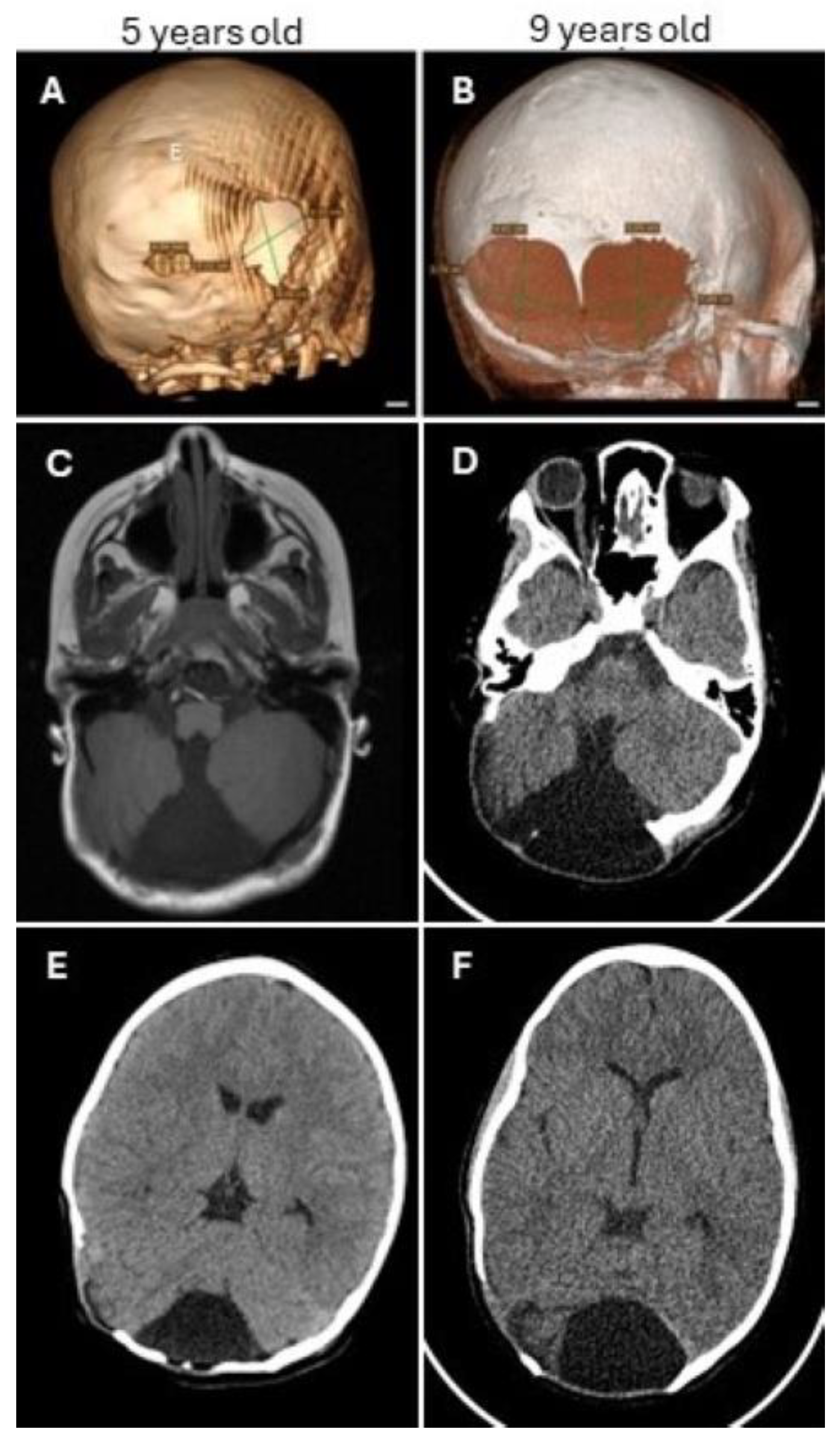 Challenges in the Management of a Calvarial Defect in an NF1-Patient