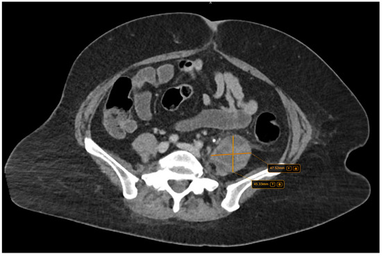Primary Iliopsoas Abscess and Drug-Induced Liver Injury in the ...
