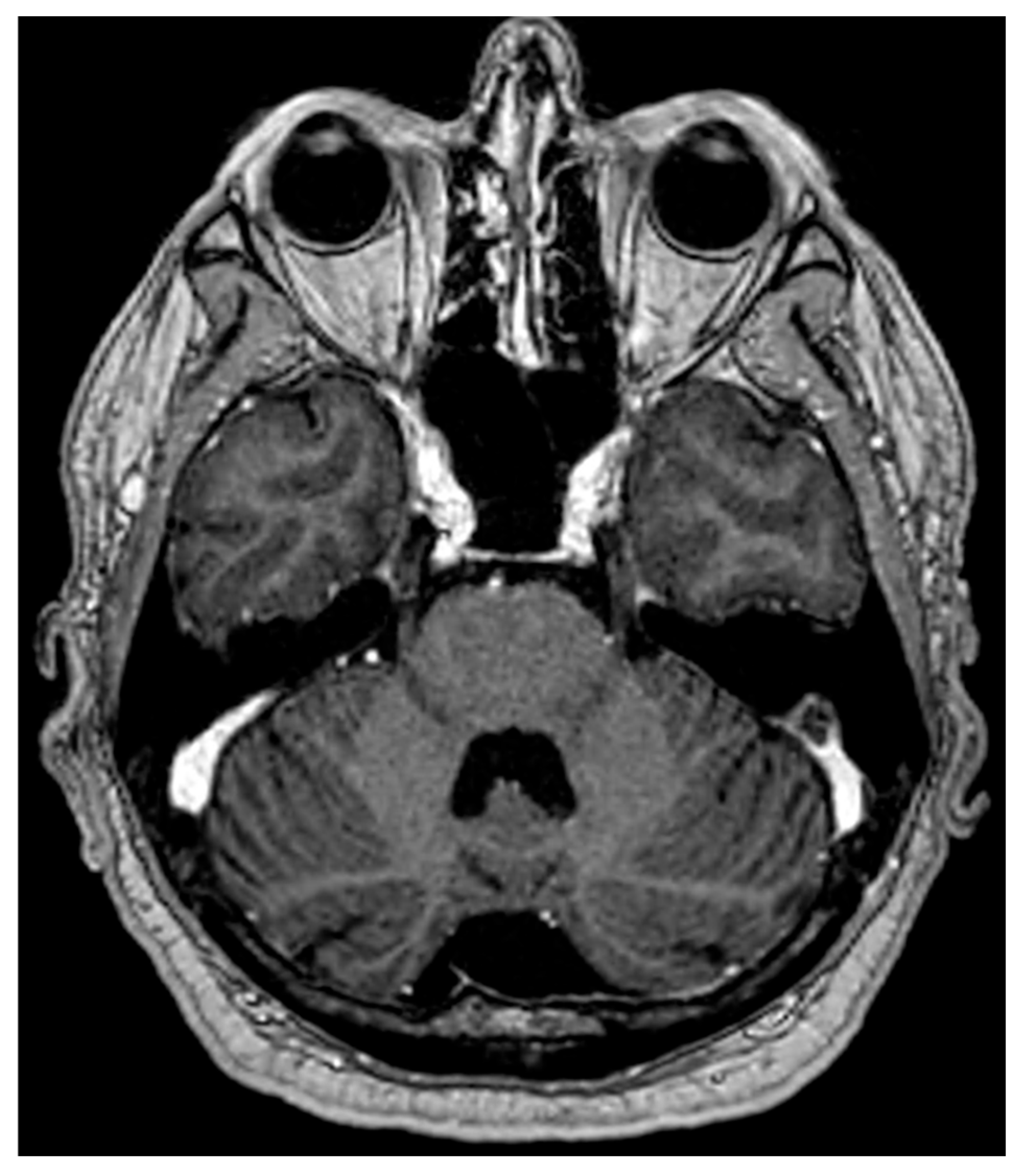 Trigeminal Nerve Mri