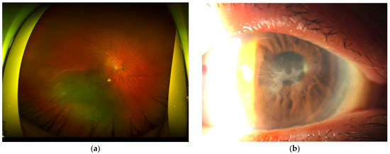 Herpes Simplex Keratitis and Vitamin D Receptor Agonist: Two Case Reports