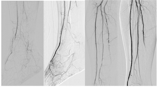 Is Global Limb Anatomic Staging System Classification a Useful Tool in ...