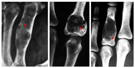 Surgical Treatment of Enchondromas of the Hand: Our Experience in ...