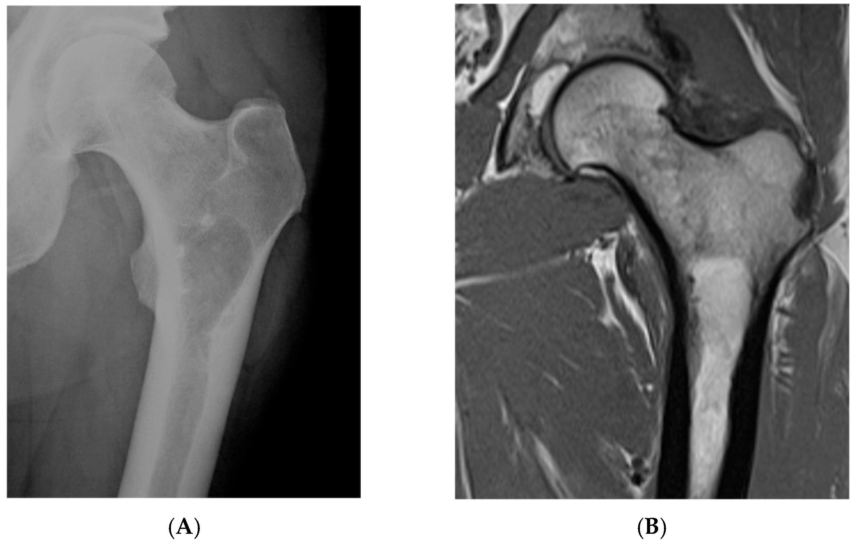 Revisiting Fat Content in Bone Lesions: Paradigms in Bone Lesion Detection