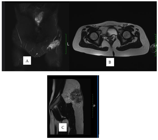 Subcutaneous Panniculitis-like T-Cell Lymphoma: Diagnostic Challenge ...