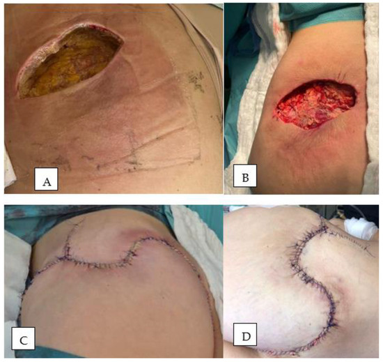 Subcutaneous Panniculitis-like T-Cell Lymphoma: Diagnostic Challenge ...
