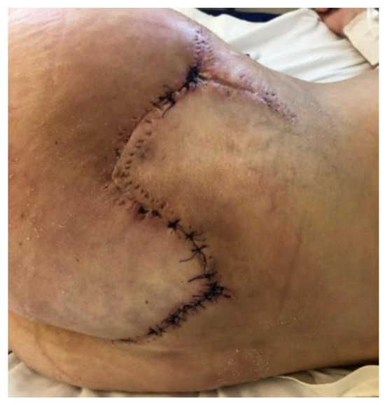 Subcutaneous Panniculitis-like T-Cell Lymphoma: Diagnostic Challenge ...