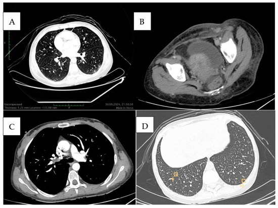 Subcutaneous Panniculitis-like T-Cell Lymphoma: Diagnostic Challenge ...