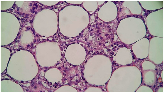 Subcutaneous Panniculitis-like T-Cell Lymphoma: Diagnostic Challenge ...