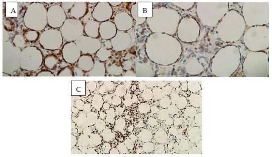 Subcutaneous Panniculitis-like T-Cell Lymphoma: Diagnostic Challenge ...