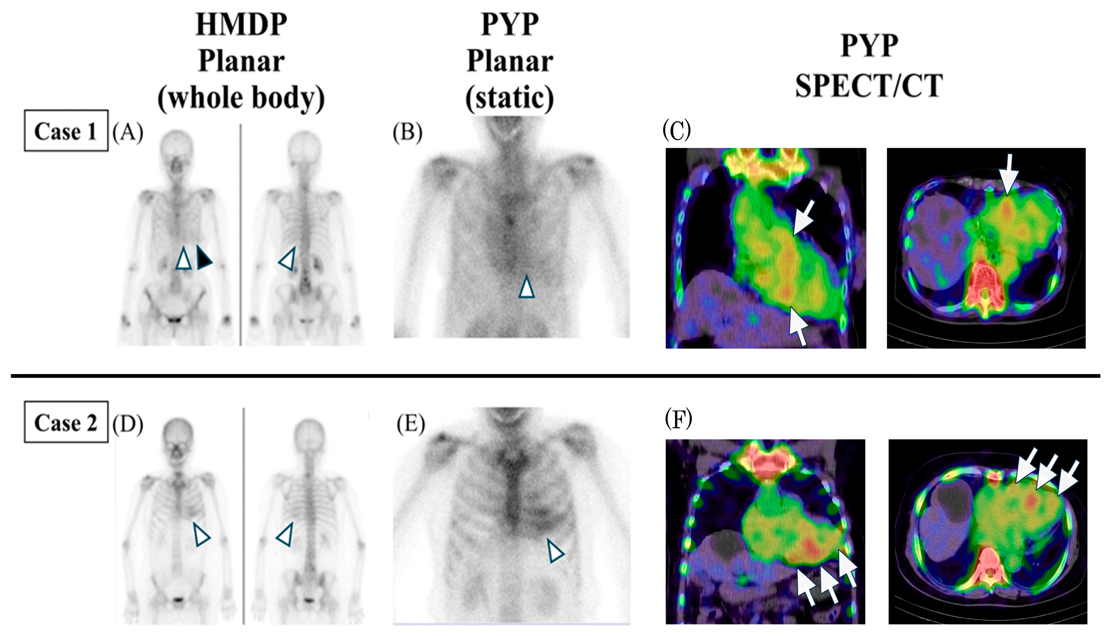Incidental Cardiac Uptake on 99mTc-HMDP Bone Scintigraphy in Oncology ...