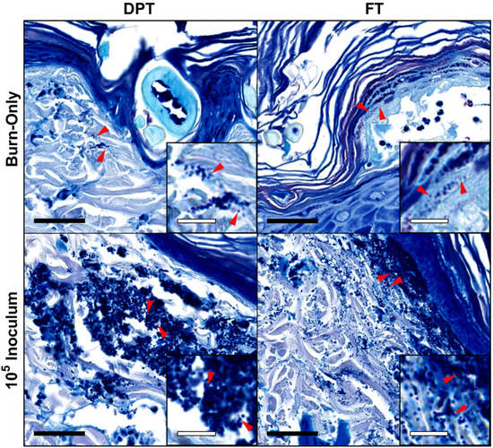 Divulging the Complexities of Deep Partial- and Full-Thickness Burn ...