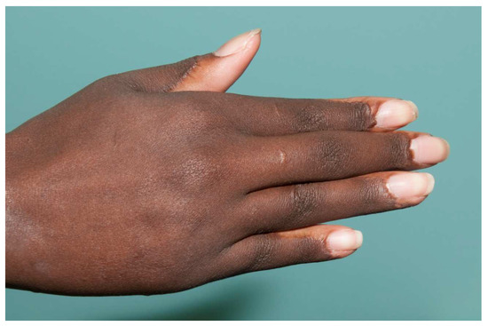 Operative Management of Burns: Traditional Care