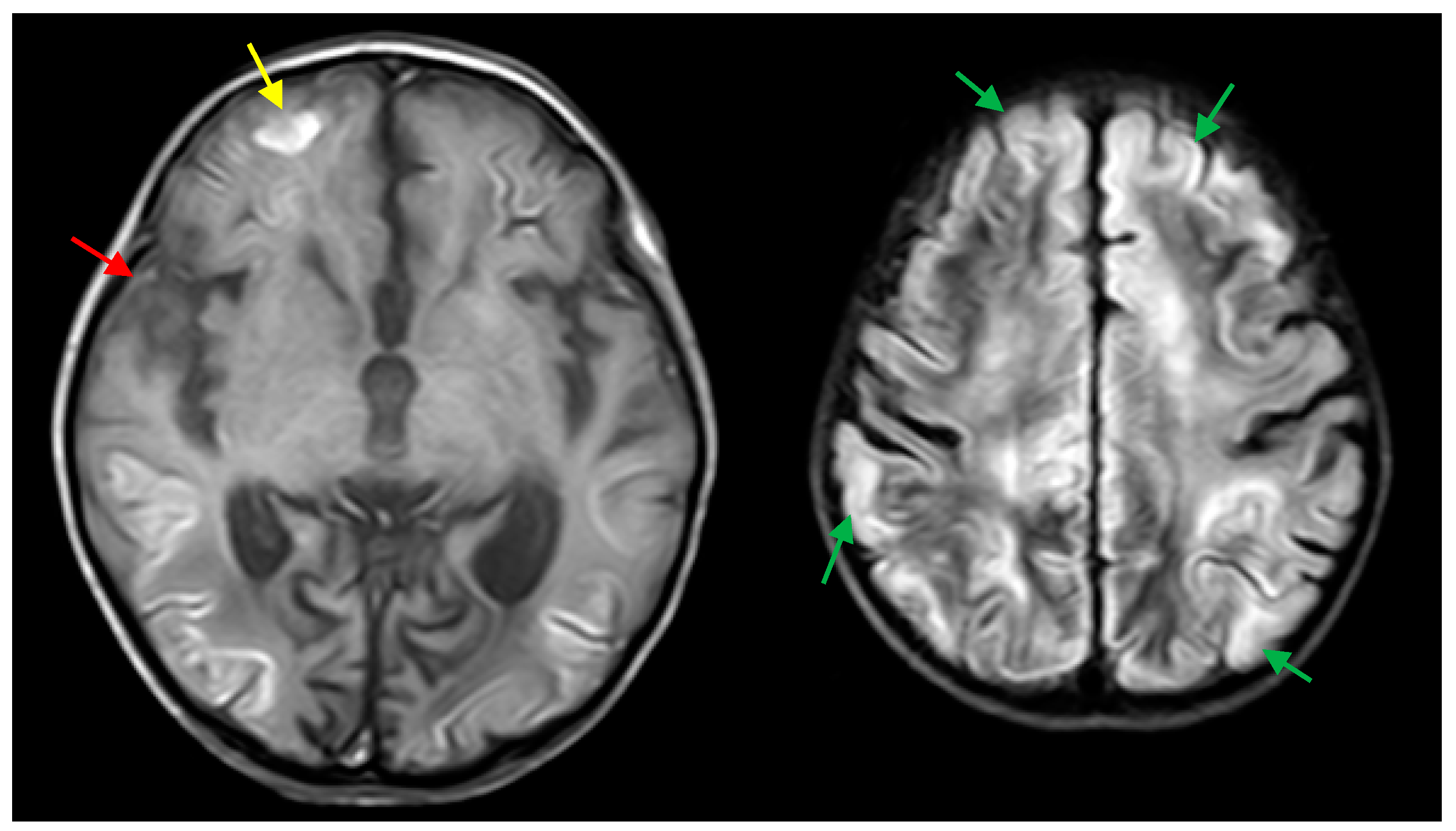 Ischemic-Hemorrhagic Stroke in New Onset Type 1 Diabetes Mellitus with ...