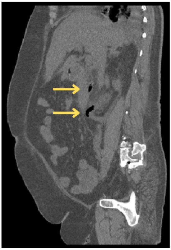 Examining Emphysematous Pyelonephritis: A Case Study on Diagnosis and ...