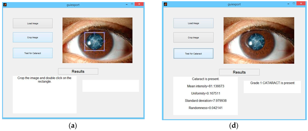 A Robust Automated Cataract Detection Algorithm Using Diagnostic ...