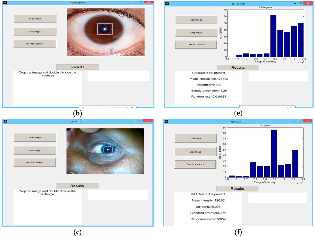 A Robust Automated Cataract Detection Algorithm Using Diagnostic Opinion Based Parameter ...