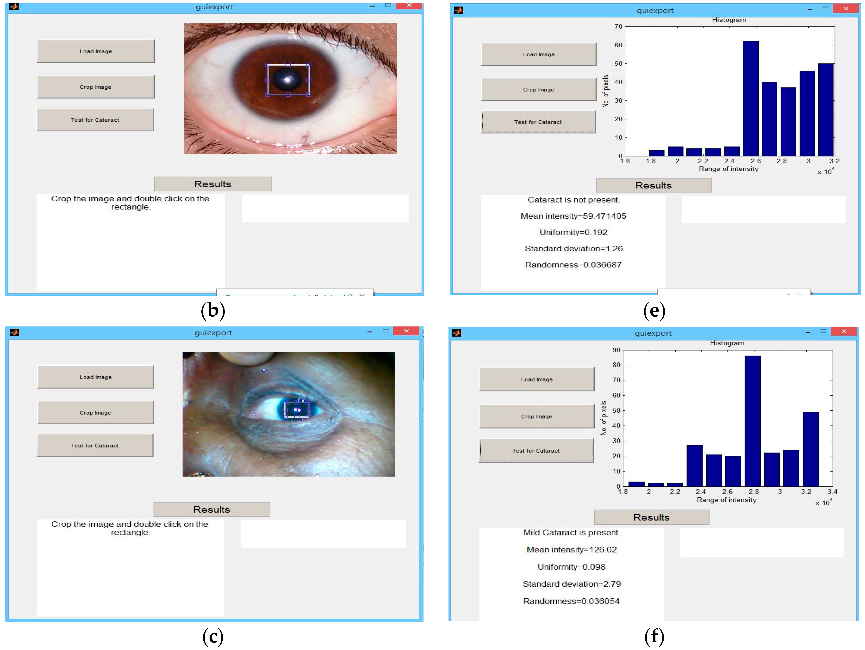 A Robust Automated Cataract Detection Algorithm Using Diagnostic