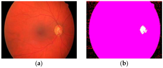 Accelerating Retinal Fundus Image Classification Using Artificial ...
