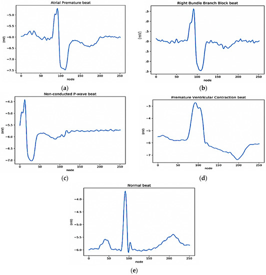 Deep Learning-Based Stacked Denoising and Autoencoder for ECG Heartbeat Classification
