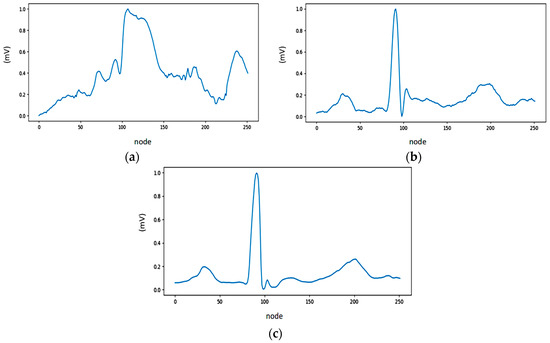 Deep Learning-Based Stacked Denoising and Autoencoder for ECG Heartbeat Classification