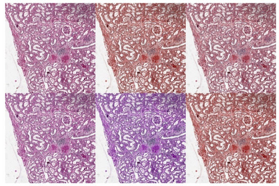Semantic Segmentation Framework for Glomeruli Detection and Classification in Kidney ...